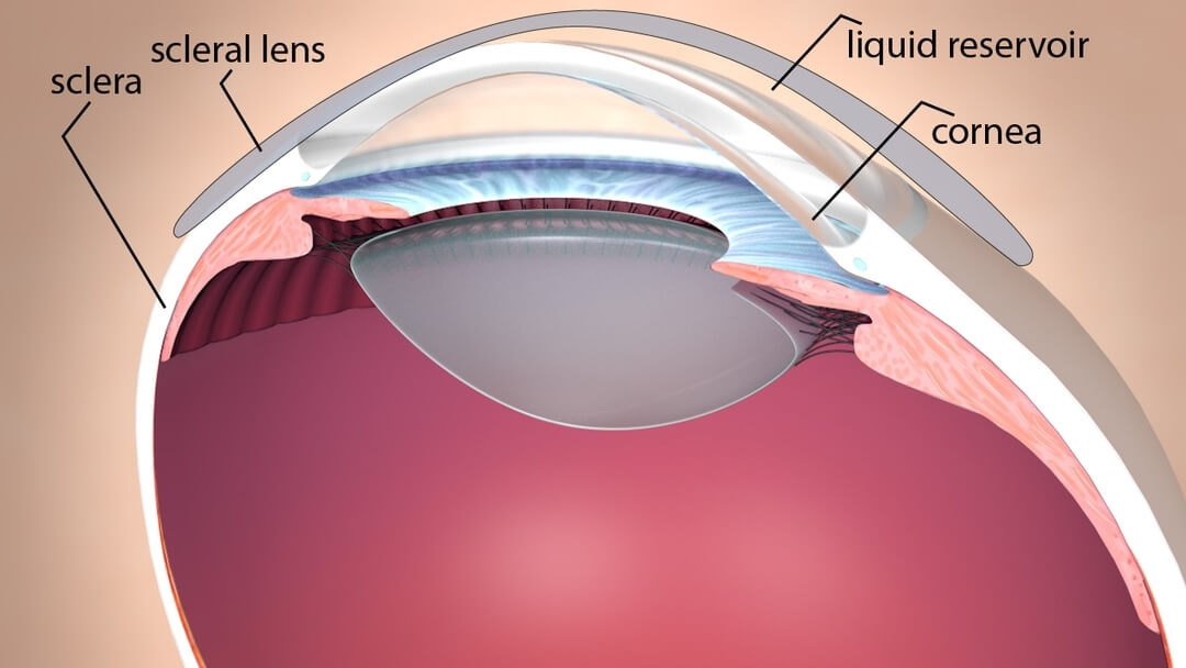 Dry Eye Treatment Houston | Dry Eye Exam Austin | Mann Eye Institute