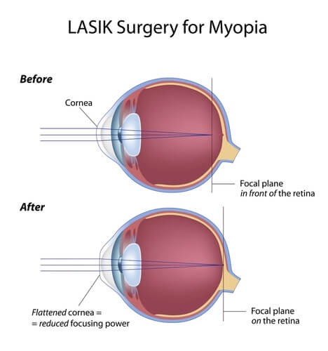LASIK in the Modern World | Mann Eye