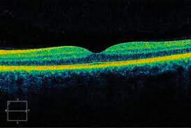 What is Epiretinal Membrane (ERM)? | Mann Eye Institute Houston