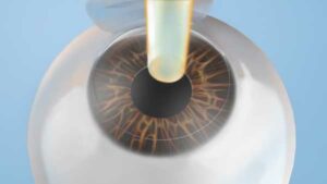 LASIK Austin | LASIK Eye Surgery Austin | Mann Eye Institute