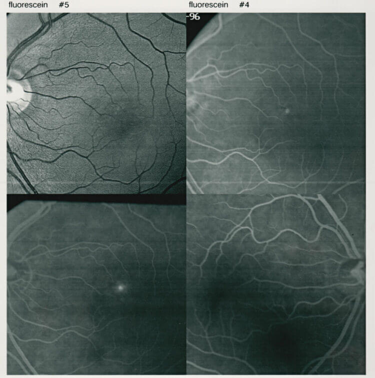 Central Serous Chorioretinopathy Houston | Mann Eye Institute Austin