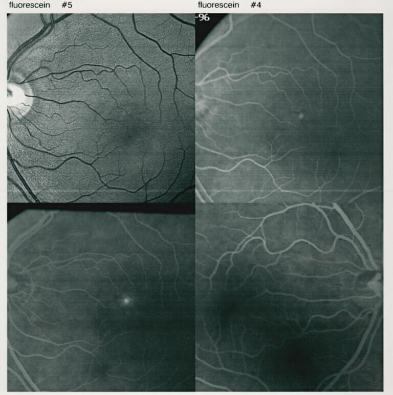 Central Serous Chorioretinopathy Houston | Mann Eye Institute Austin